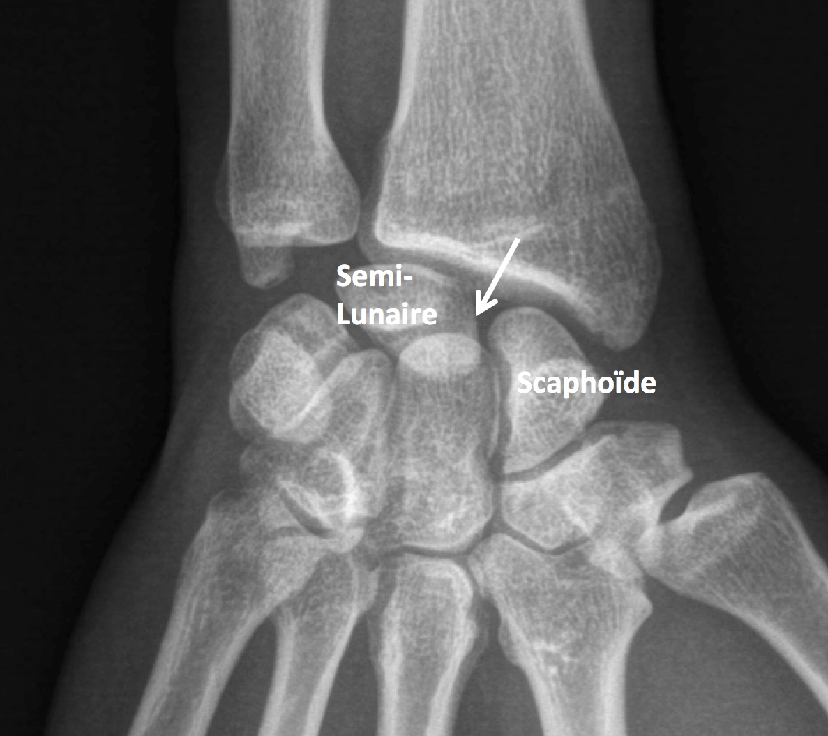 Entorses Du Poignet Lésions Ligamentaires Clinique Ostéo